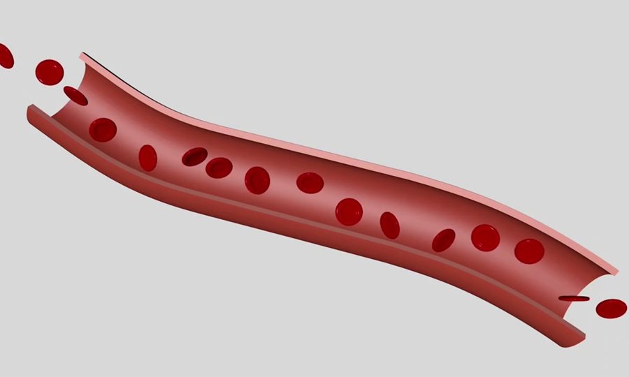 Herseninfarct - Youngstroketoolbox