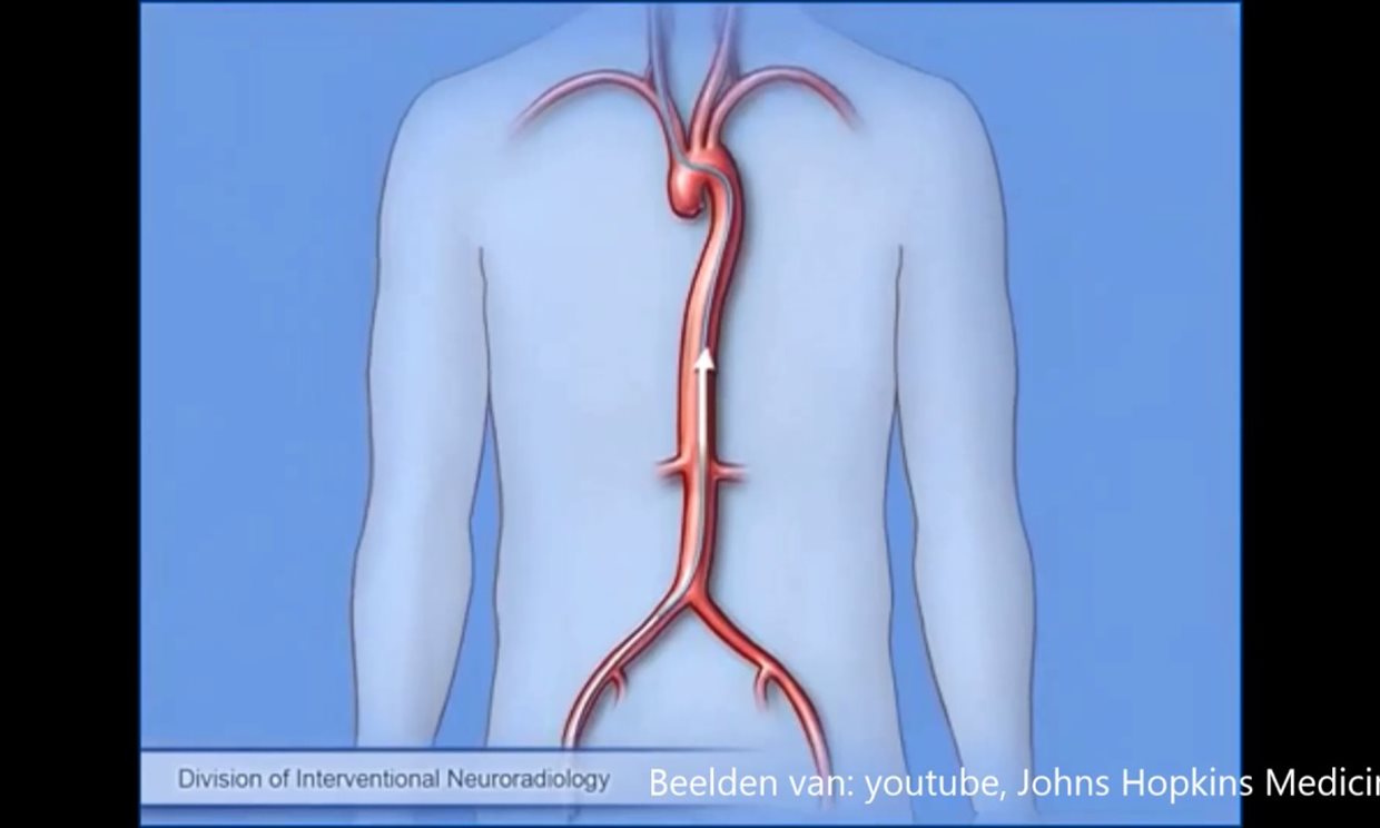 Arteriovenous malformation (AVM) in the brain - Vascular tangle in the ...